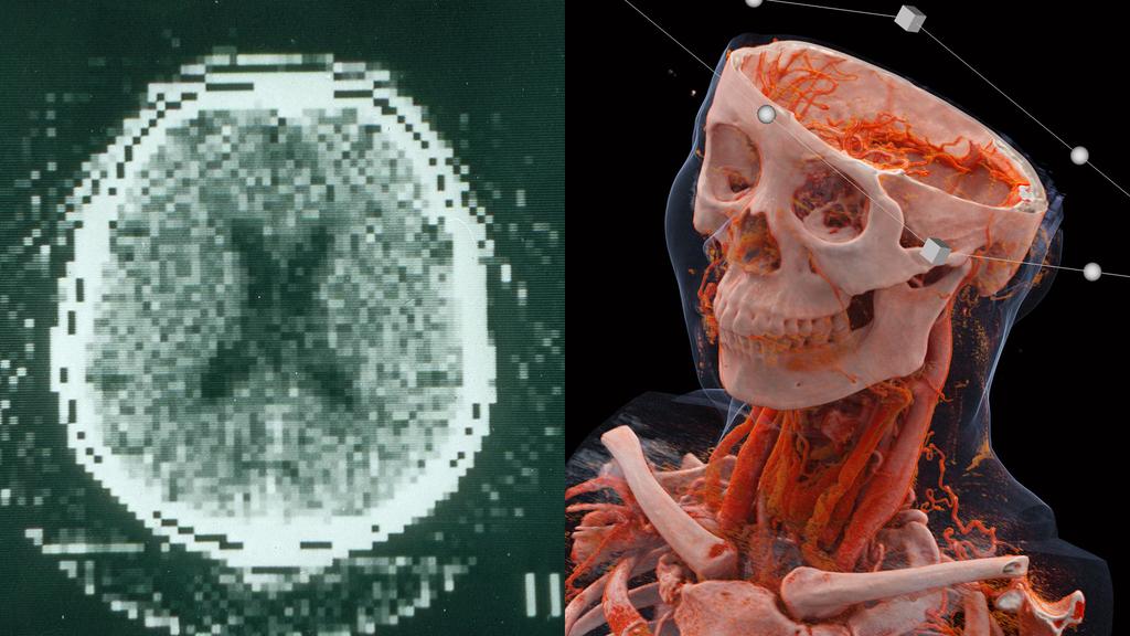 History of CT (computed tomography)