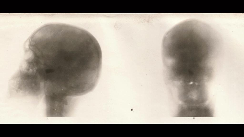 X-ray examination of the brain