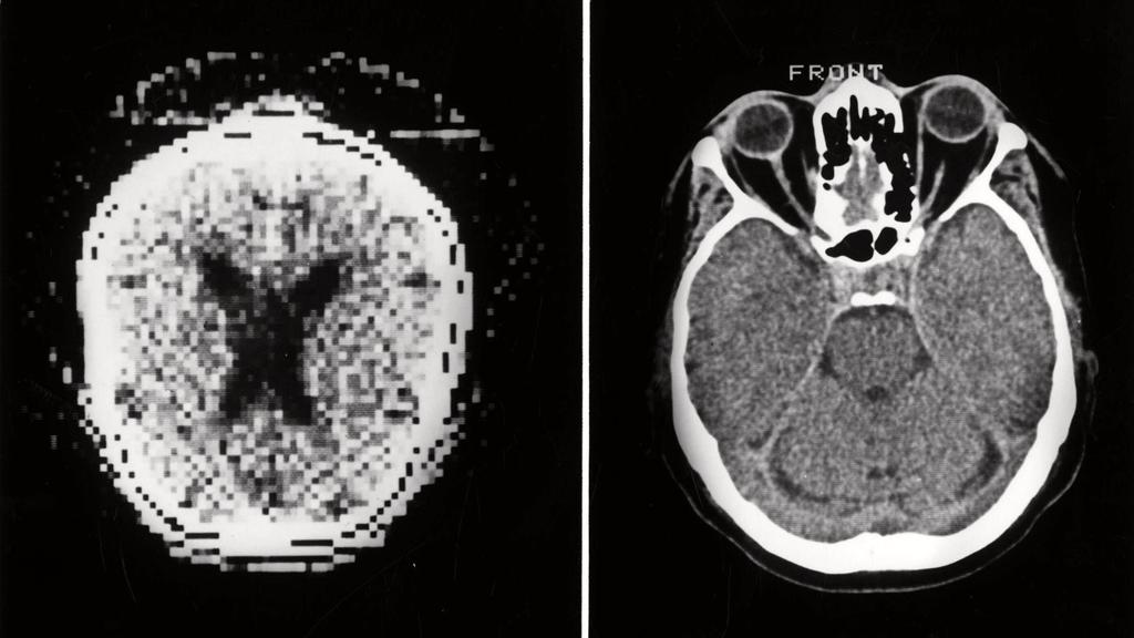 X-ray examination of the brain